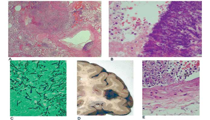 Fungal Bronchitis